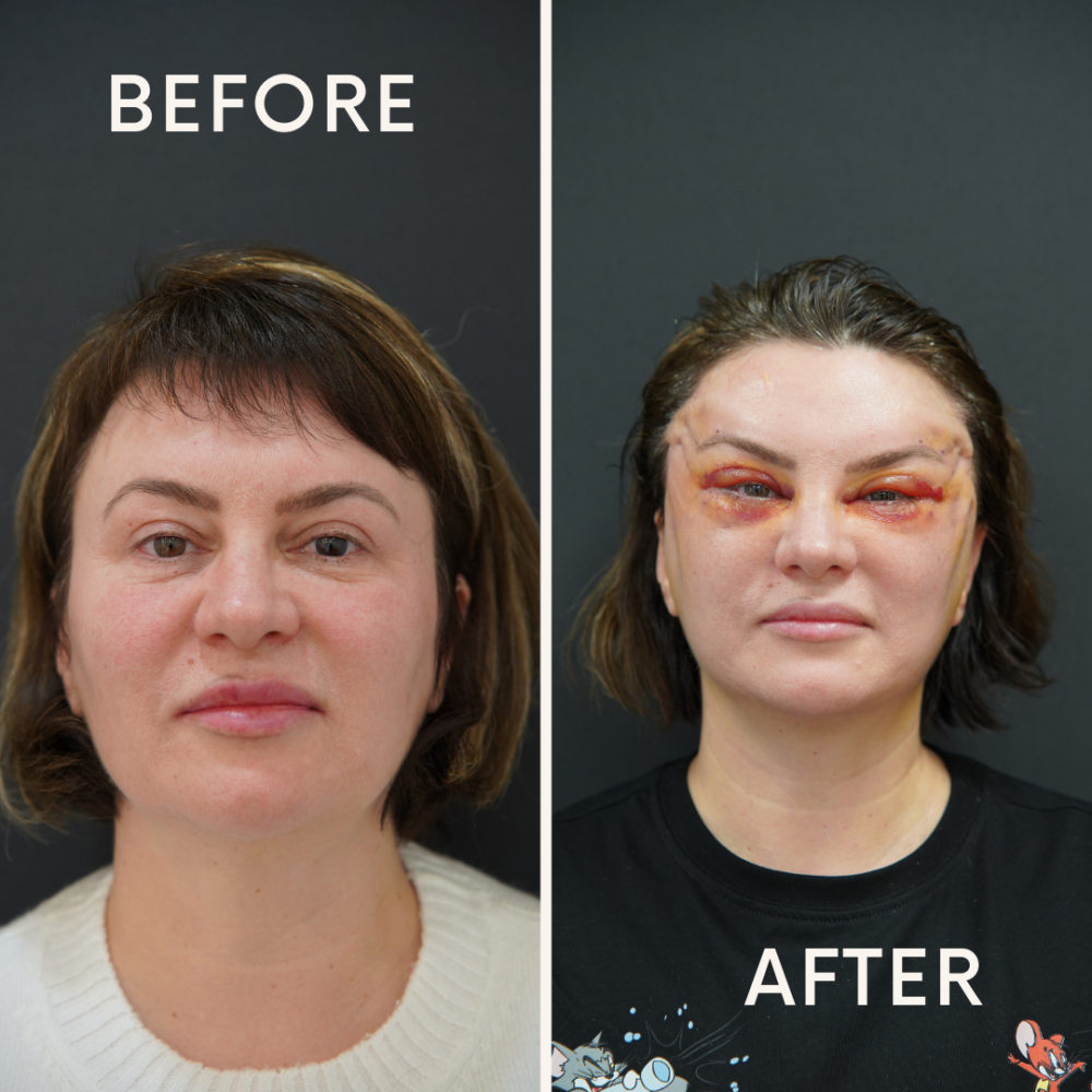 Blepharoplasty in Turkey - Eyelid Surgery
