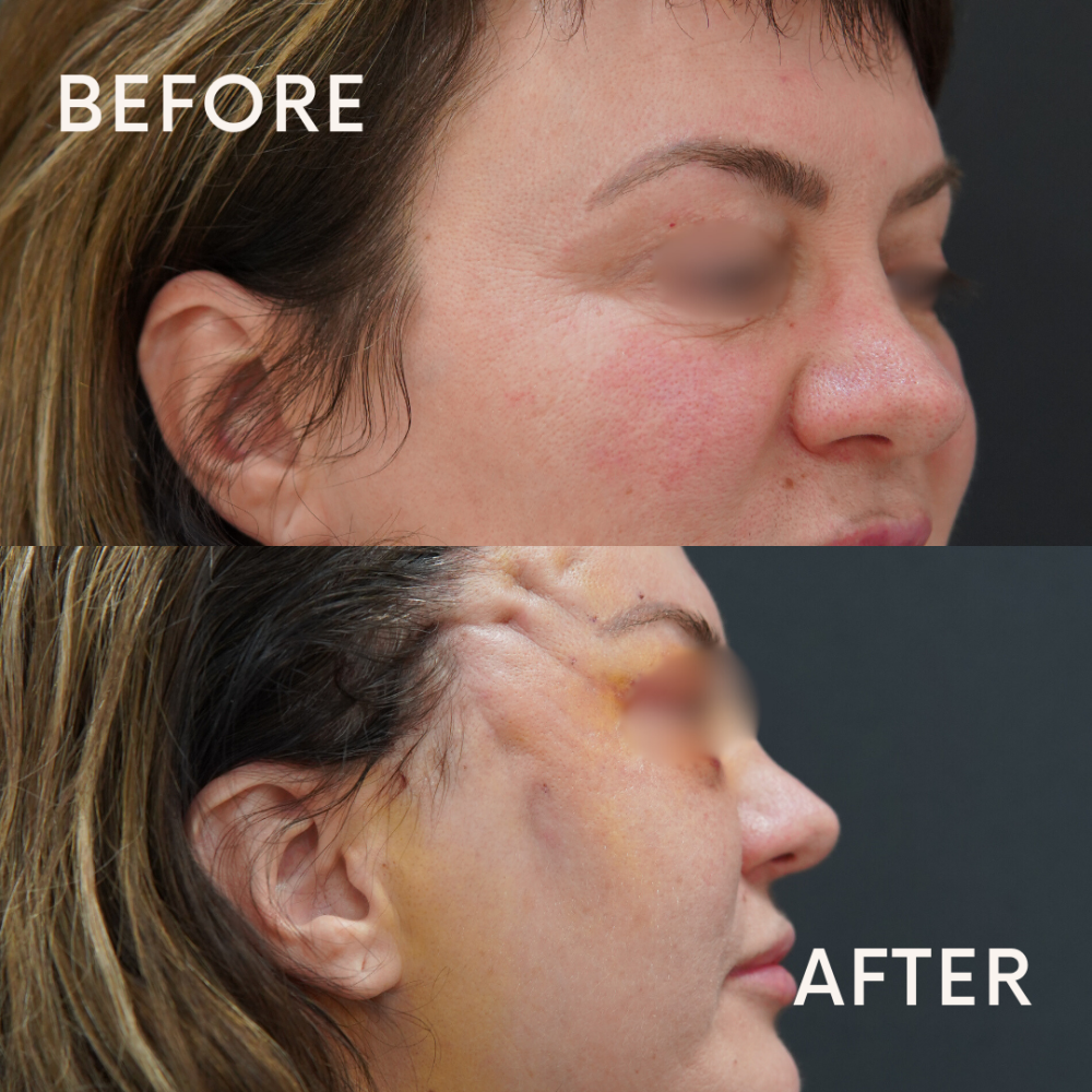 Temporal Lift Surgery in Istanbul, Temple Fillers, and Temporal Lifting