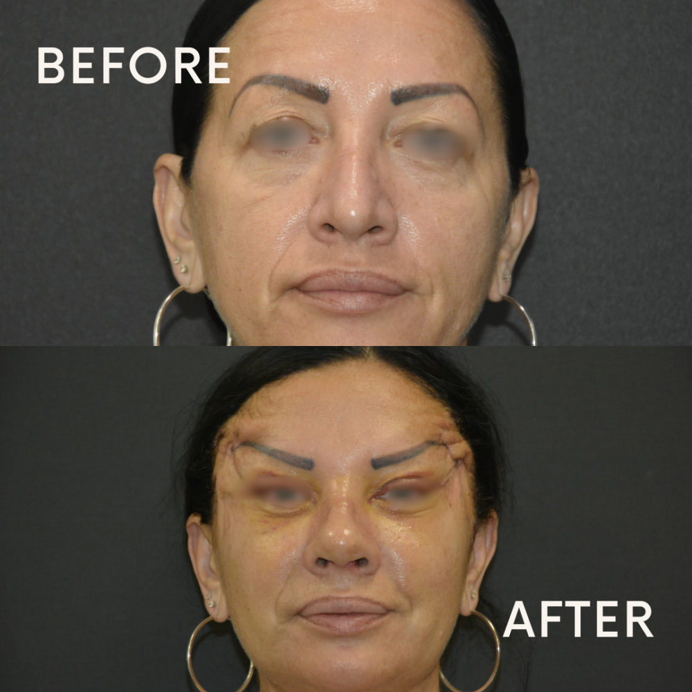 Temporal Lift Surgery in Istanbul, Temple Fillers, and Temporal Lifting