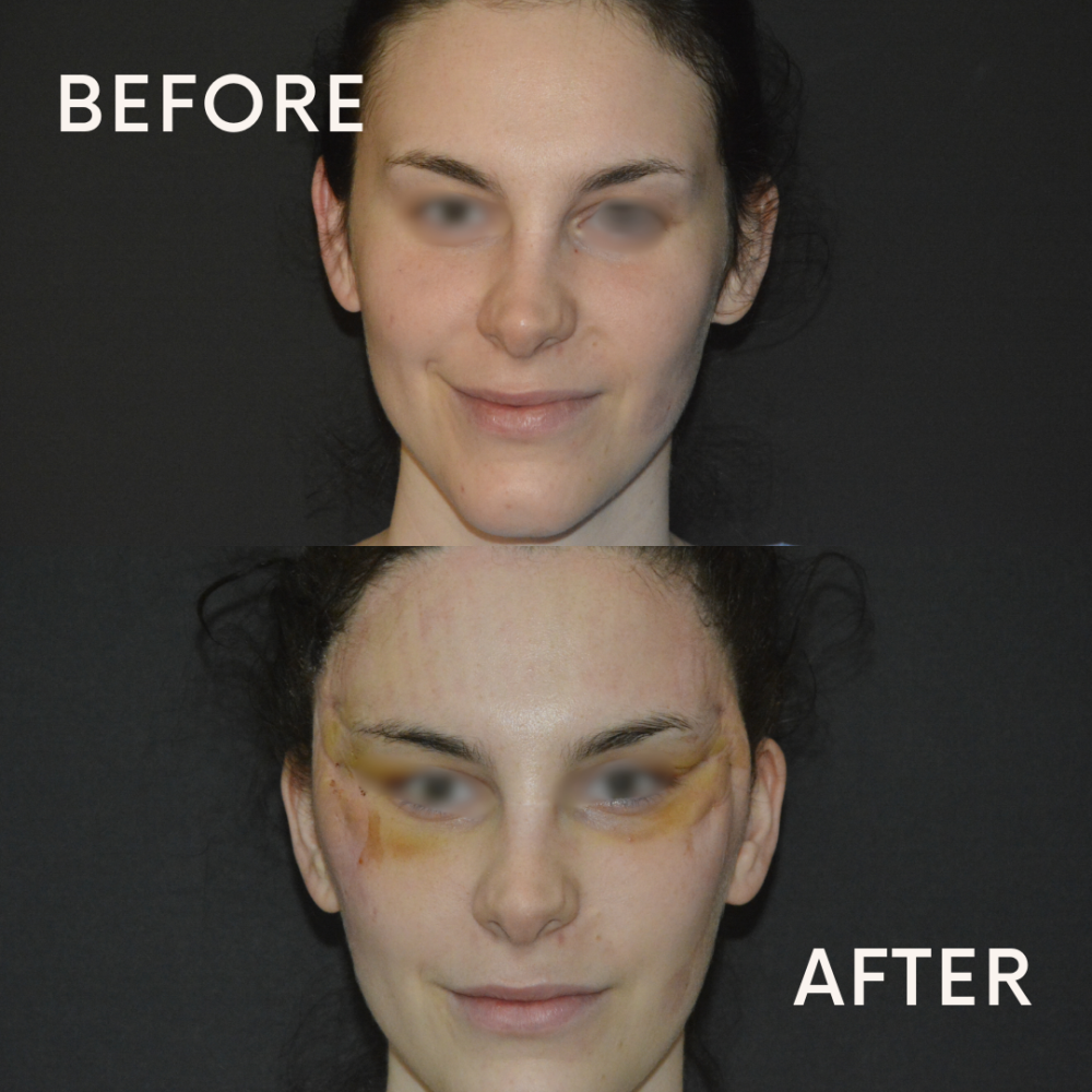 Temporal Lift Surgery in Istanbul, Temple Fillers, and Temporal Lifting