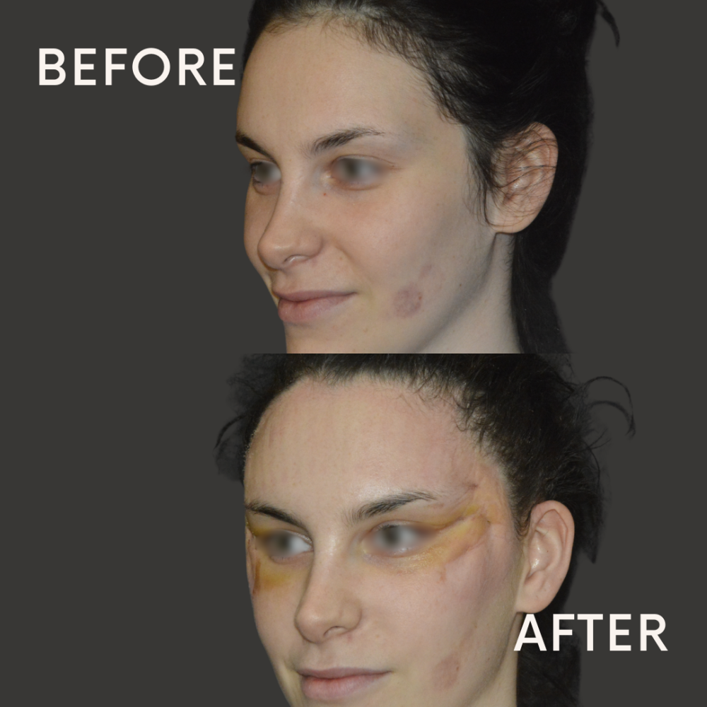 Temporal Lift Surgery in Istanbul, Temple Fillers, and Temporal Lifting