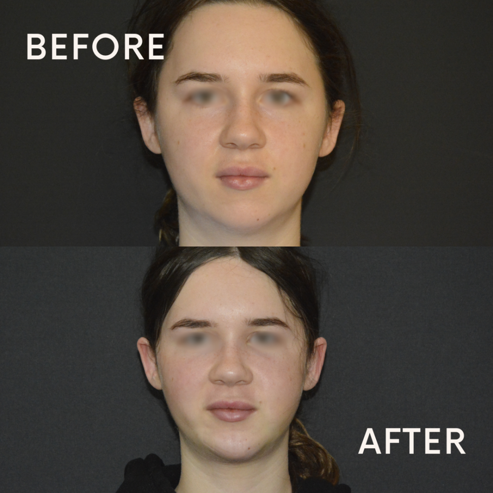 Temporal Lift Surgery in Istanbul, Temple Fillers, and Temporal Lifting