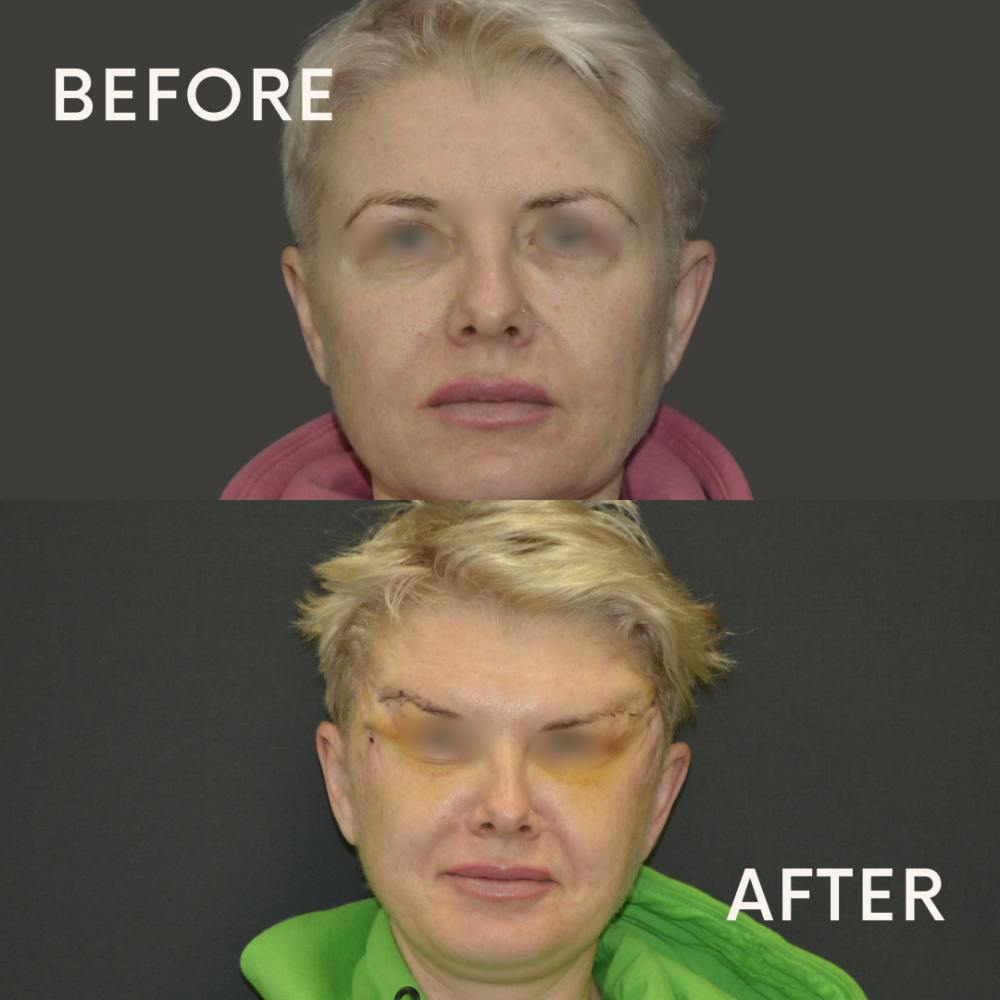 Temporal Lift Surgery in Istanbul, Temple Fillers, and Temporal Lifting